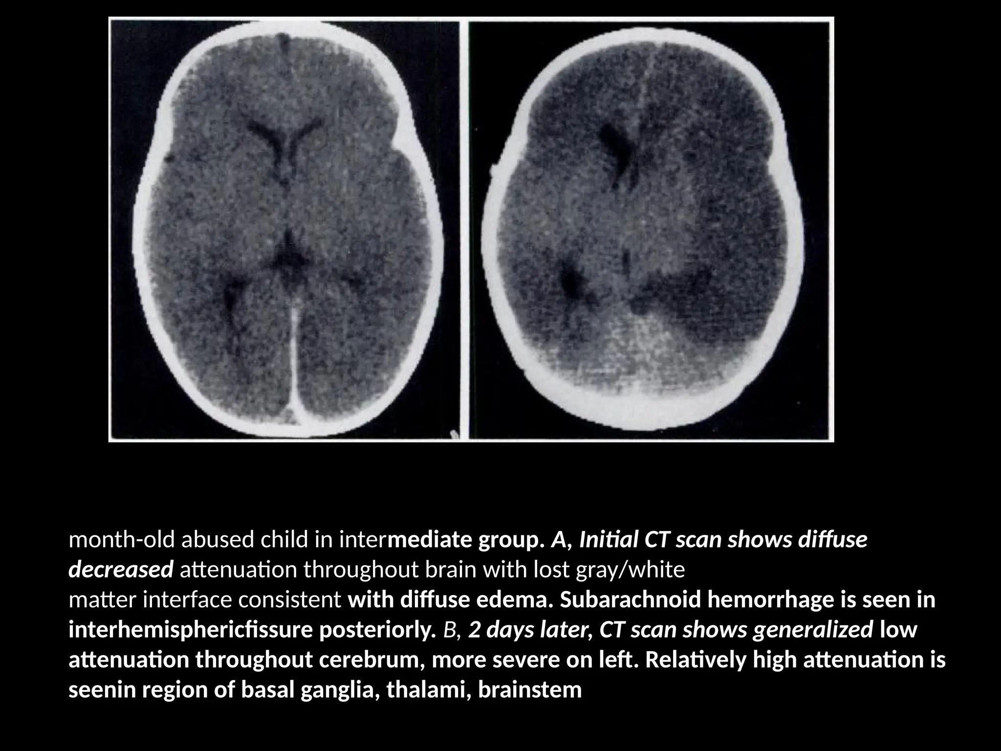 HIE.rkg.pptx hypoxic ischemic encephalitis | PPTX