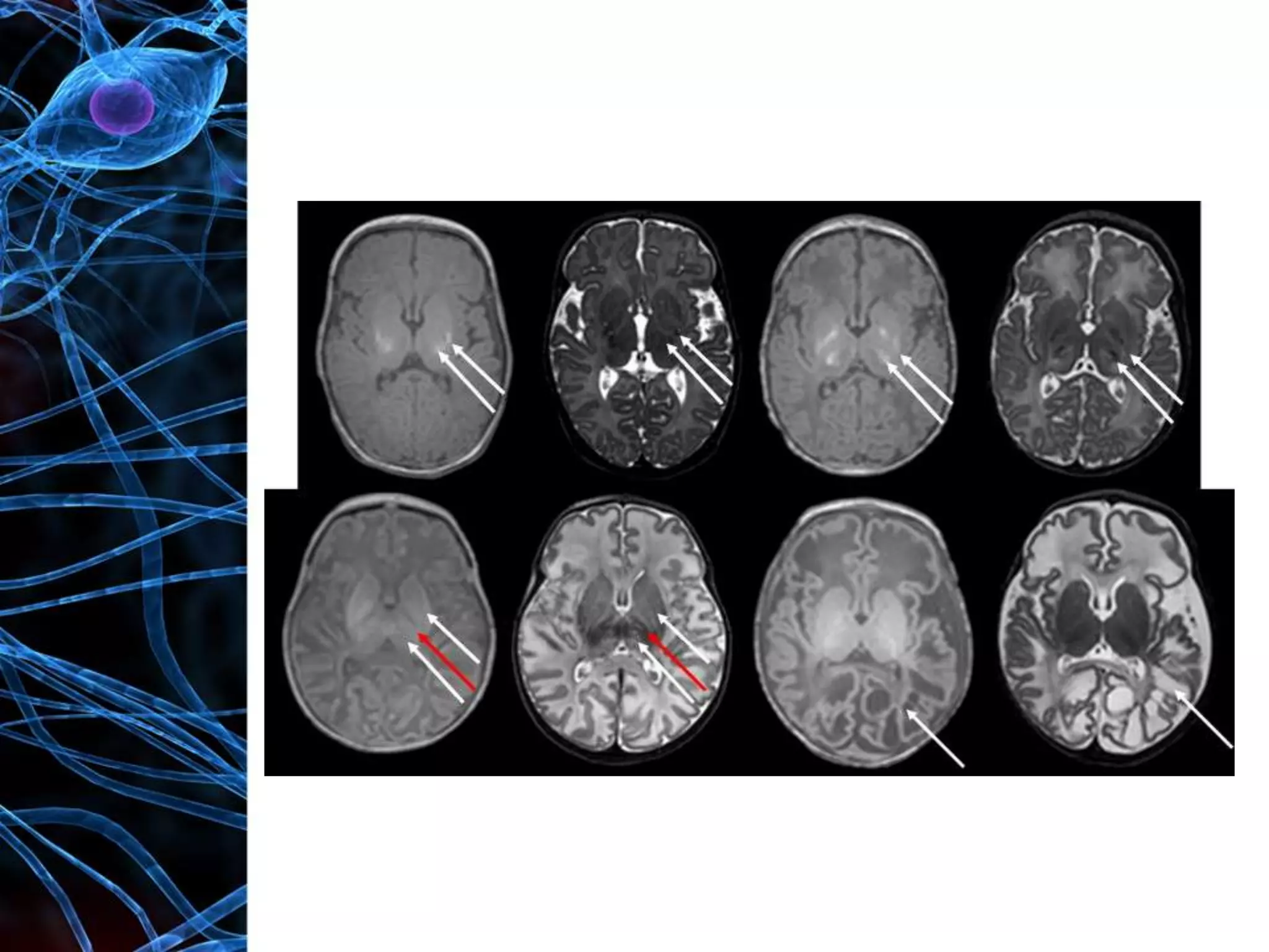 Hypoxic Ischemic Encephalopathy | PPTX