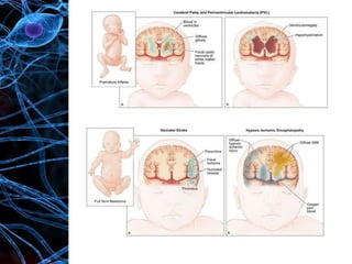 Hypoxic Ischemic Encephalopathy | PPTX