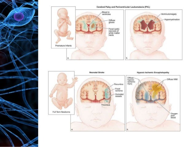 Hypoxic Ischemic Encephalopathy