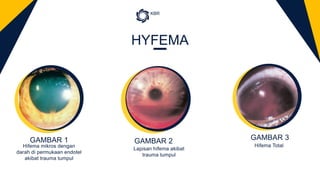 HIfema Classification and Management Presentation | PPTX