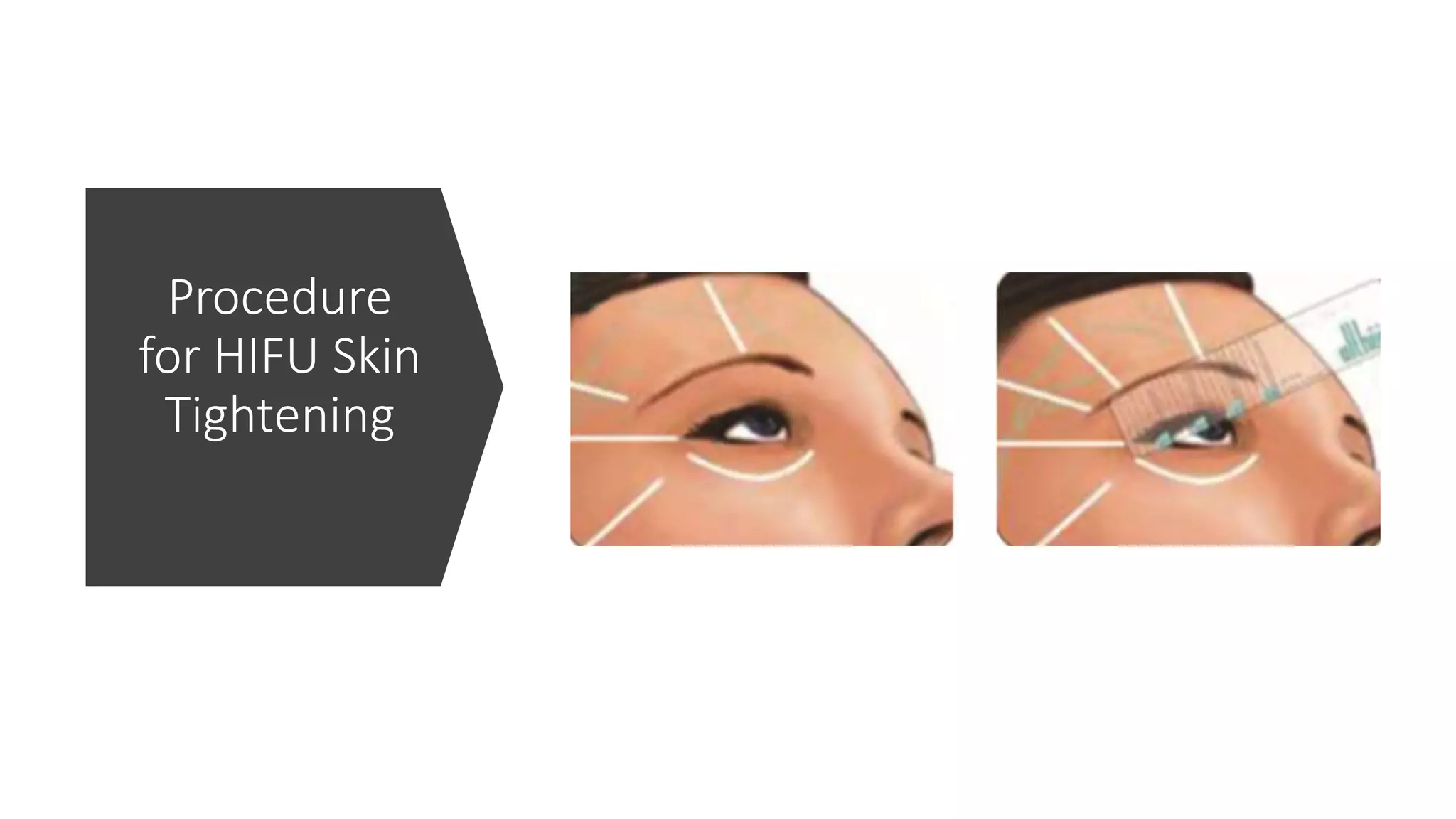 HIFU Treatment - Dermosphere Clinic.pptx