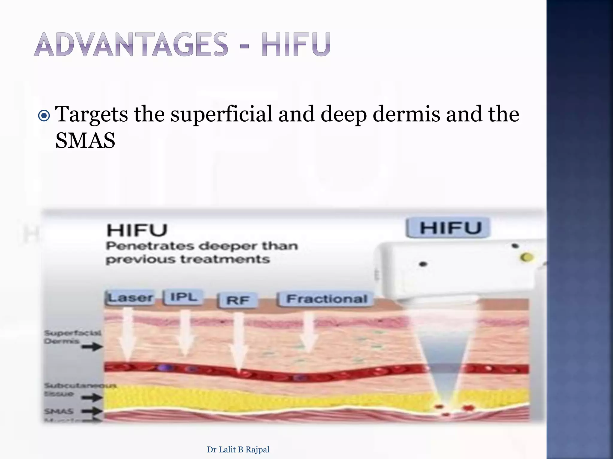 HIFU- DR LALIT RAJPAL | PPTX