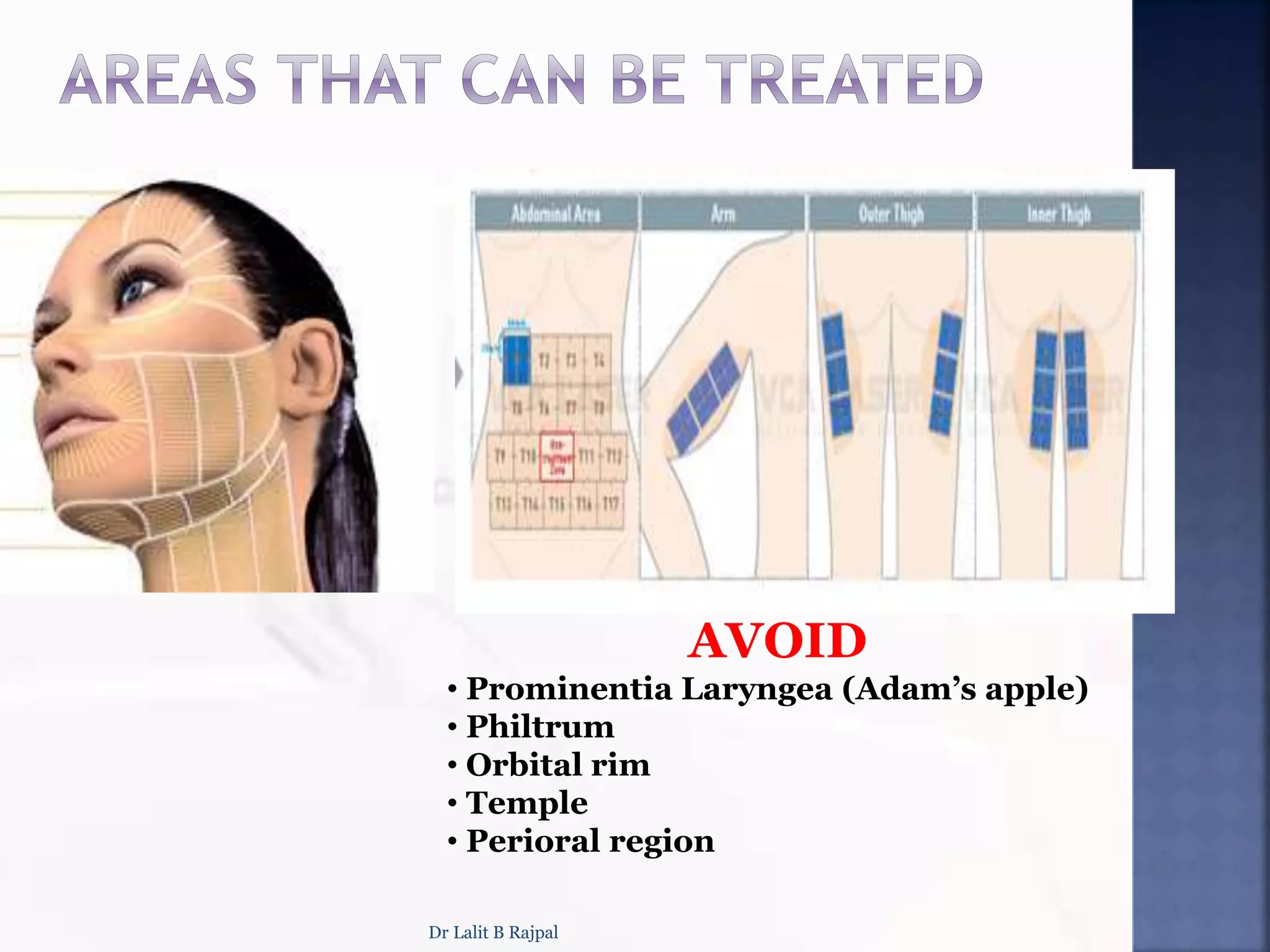 HIFU- DR LALIT RAJPAL | PPTX