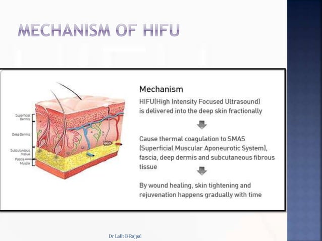 HIFU- DR LALIT RAJPAL | PPTX | Skin and Dermatology | Diseases and ...