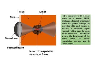 HIFU & LITT.pptx