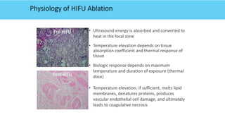 前列腺局灶治療 HIFU | PPT