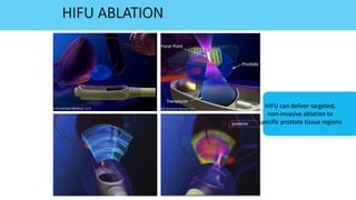 前列腺局灶治療 HIFU | PPT