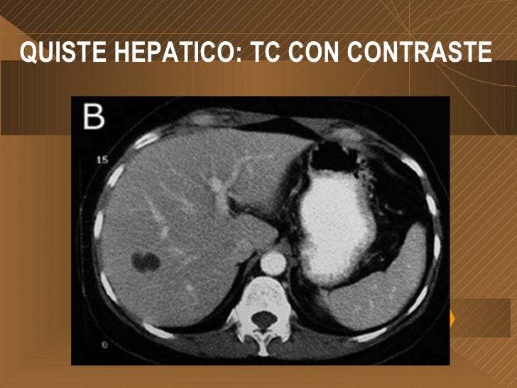 radologia de Higado