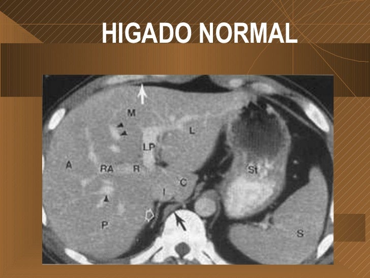 radologia de Higado