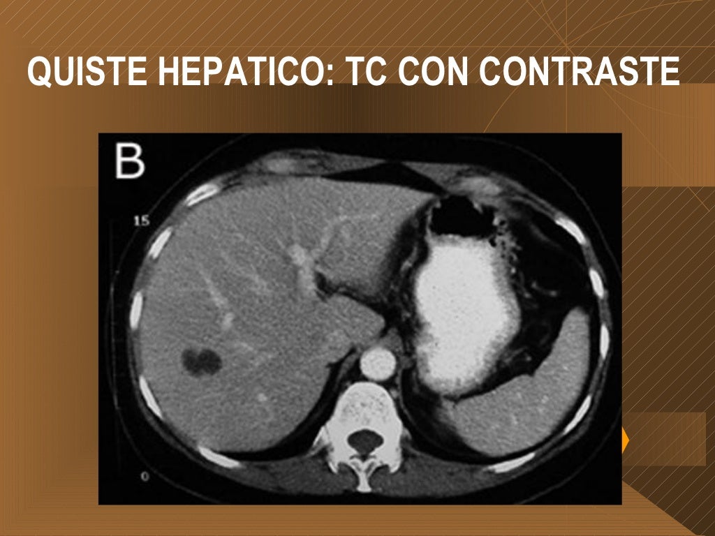 RADIOLOGIA Higado DRA MARROQUIN