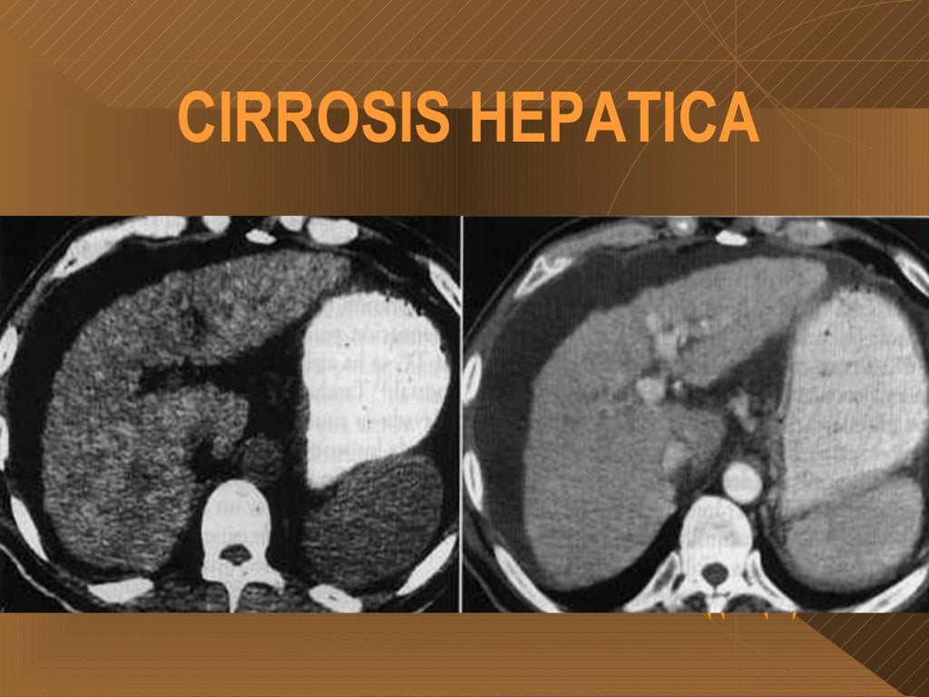 RADIOLOGIA Higado DRA MARROQUIN