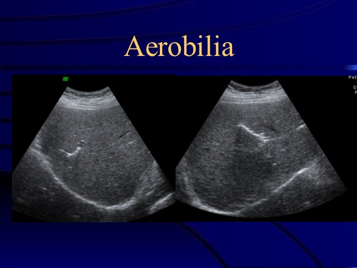 Aerobilia Radiopaedia _ Colonic diverticulitis – YWOJ