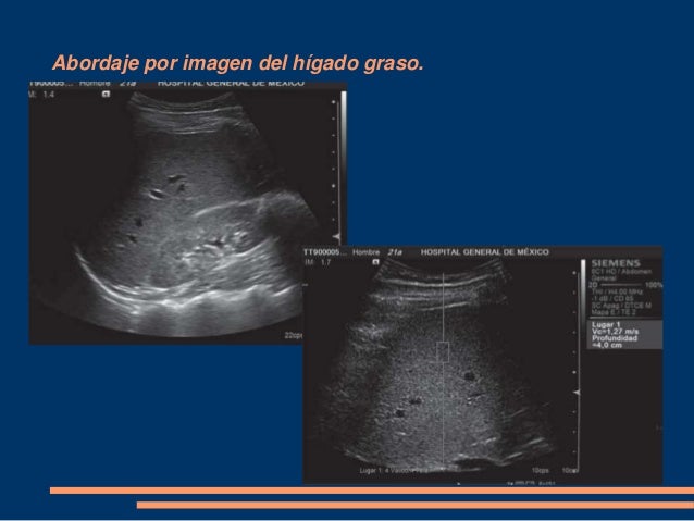 Higado graso abordaje por imagen