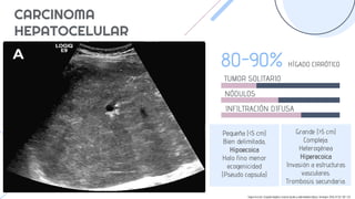 Ecografia Abdominal Higado patologico | PPTX