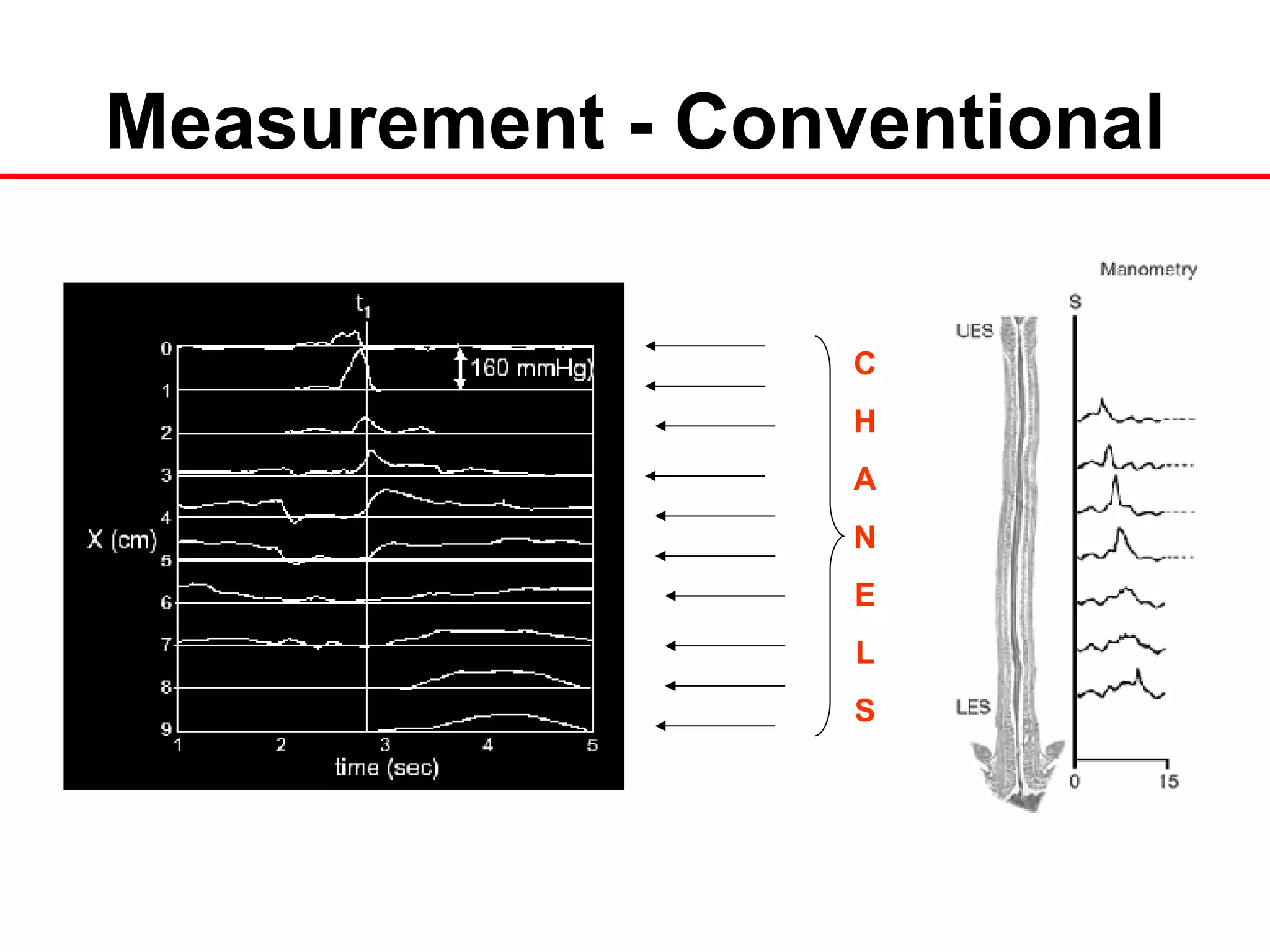 High Resolution Manometry Introduction2 | PPT
