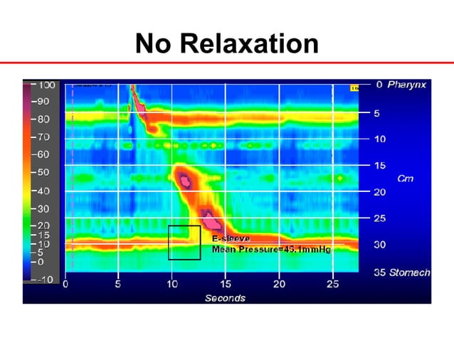 High Resolution Manometry Introduction2 | PPT | Digestive Disorders ...
