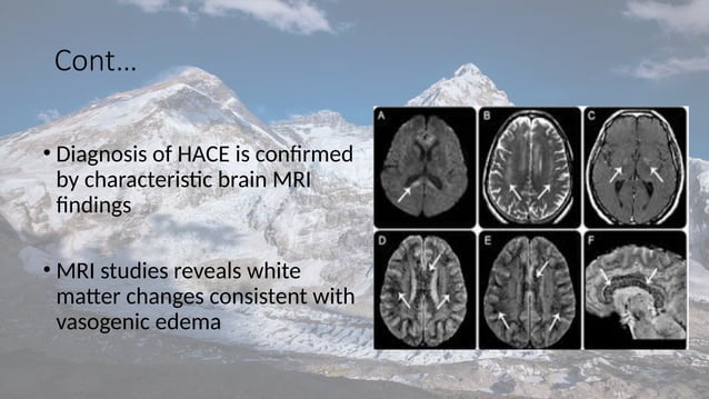 Physiology and pathophysiology of HIGH ALTITUDE disorders | PPTX