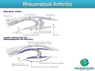 Arthritis | PPT