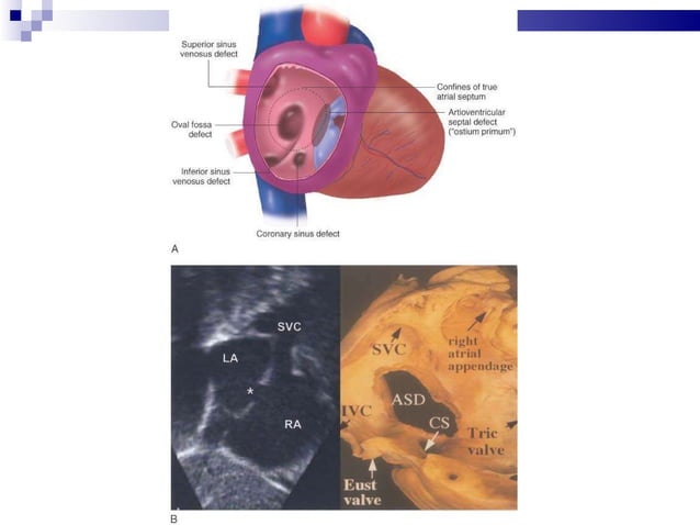 ASD and VSD Closure | PPT
