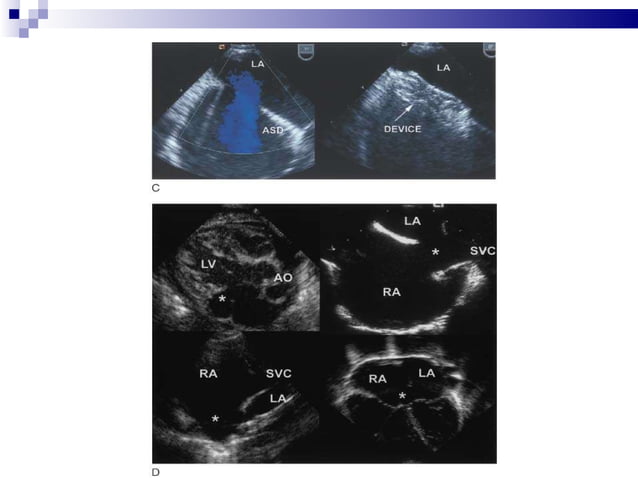 ASD and VSD Closure | PPT