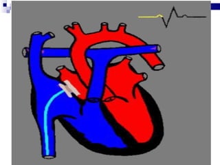 ASD and VSD Closure | PPT