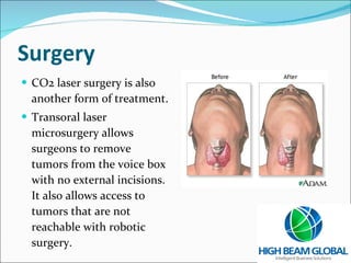 Head and Neck Cancer | PPT