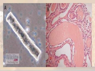 High cut off dialysis and multiple myeloma | PPSX