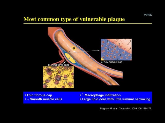 High dose statins in plaque stabilization | PPT