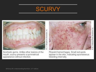 High dose vitamin c in cosmetic dermatology | PPTX