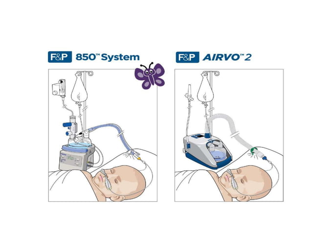 High flow nasal cannula in neonataes