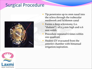 High Frequency Deep Sclerotomy (HFDS) | PPTX