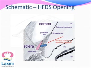 High Frequency Deep Sclerotomy Hfds Pptx