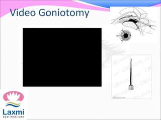 High Frequency Deep Sclerotomy (HFDS) | PPTX