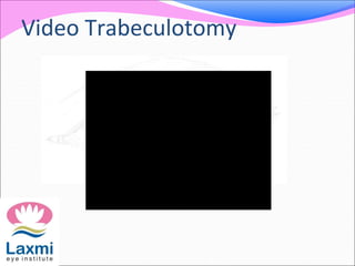 High Frequency Deep Sclerotomy (HFDS) | PPTX