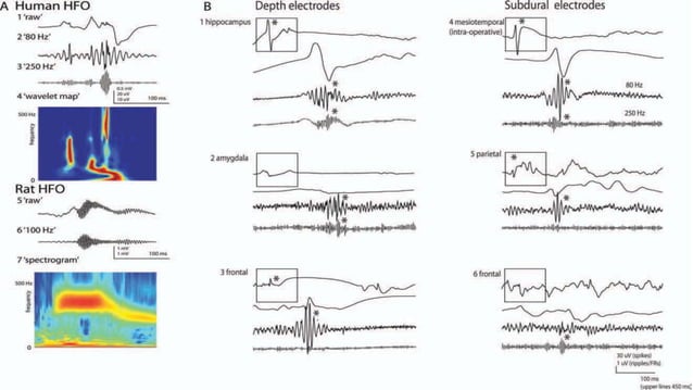 High frequency oscillations | PPTX | Brain and Nervous System Disorders ...