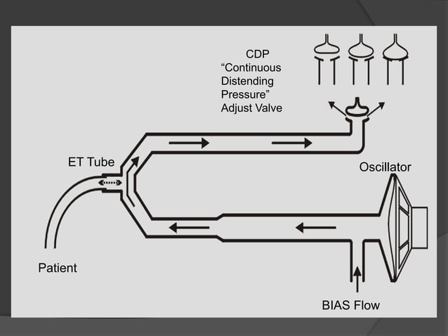 High Frequency Oscillatory Ventilation | PPTX