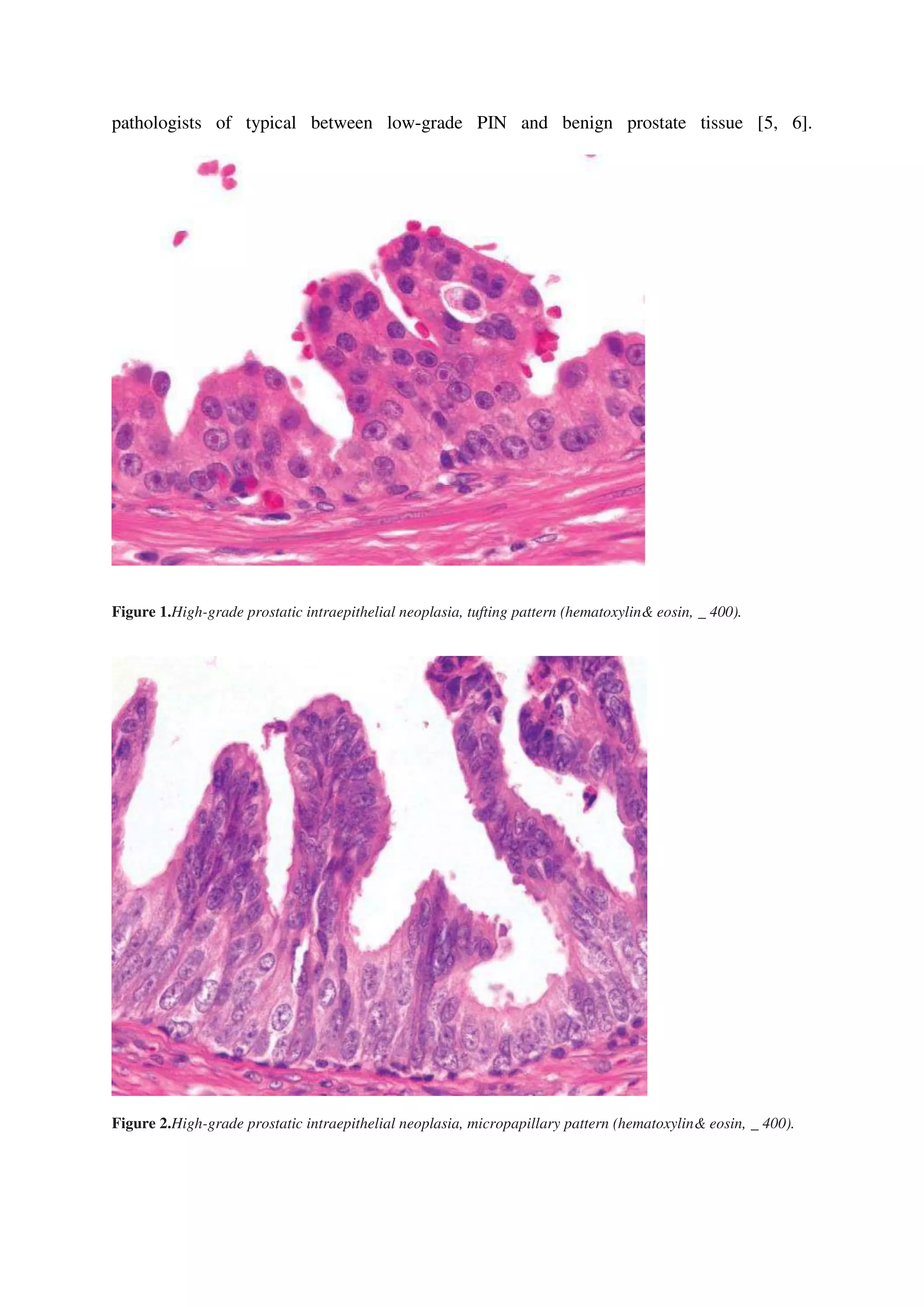 High grade prostatic intraepithelial neoplasia | PDF