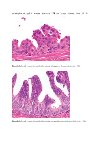 High grade prostatic intraepithelial neoplasia | PDF
