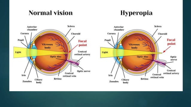 High hyperopia.pptx