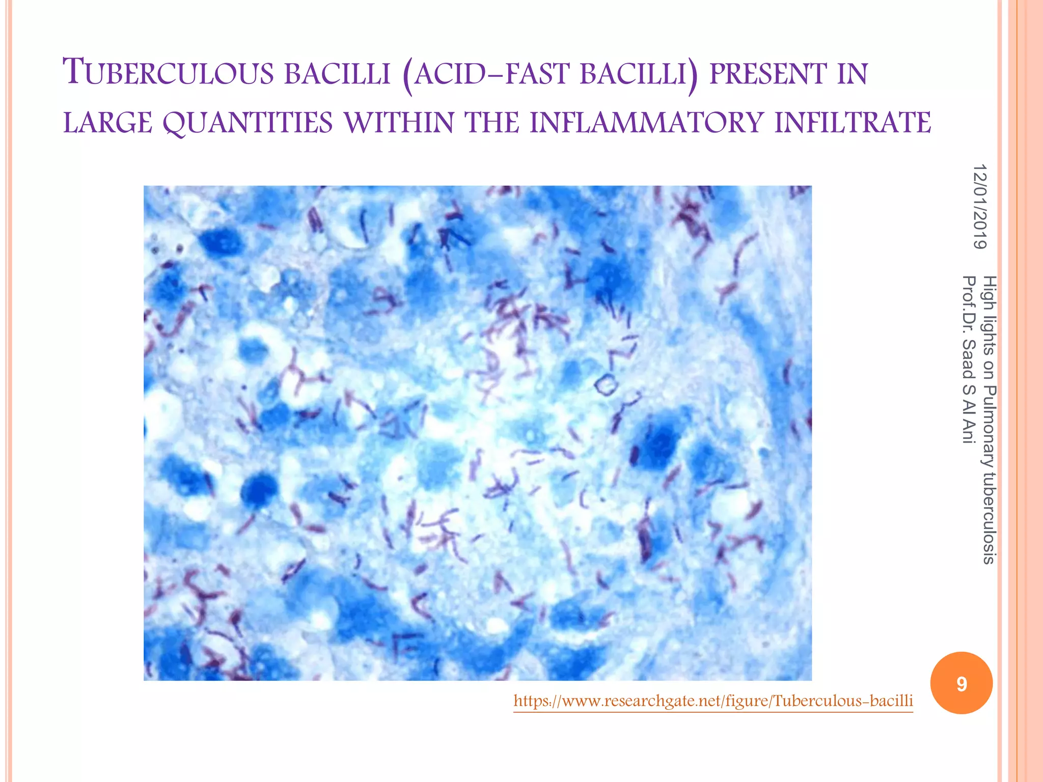 High lights on pulmonary tuberculosis | PPT