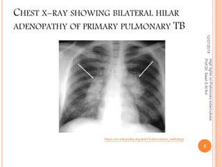 High lights on pulmonary tuberculosis | PPT