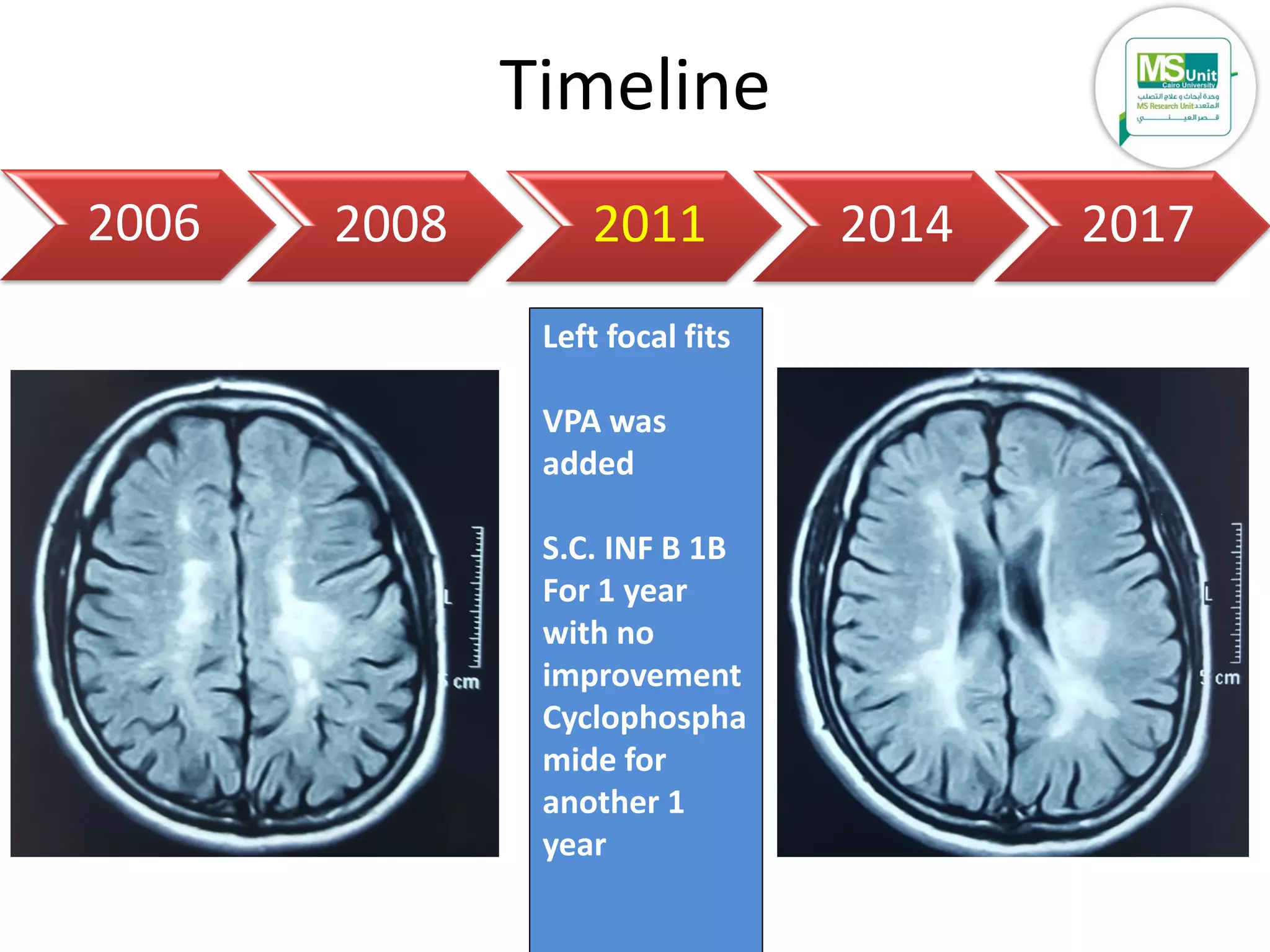 Highly active multiple sclerosis | PPT
