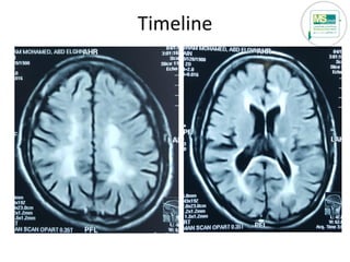 Highly active multiple sclerosis | PPT