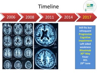 Highly active multiple sclerosis | PPT