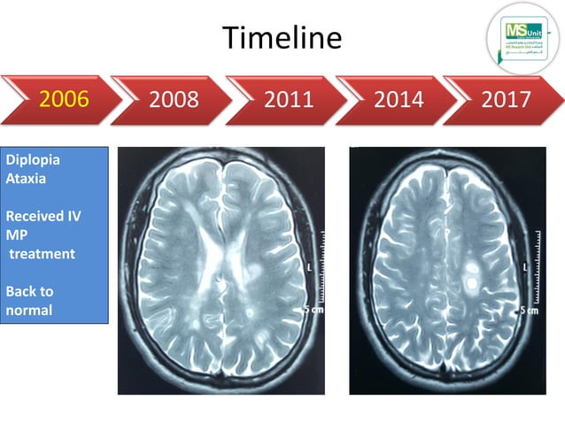 Highly active multiple sclerosis | PPT