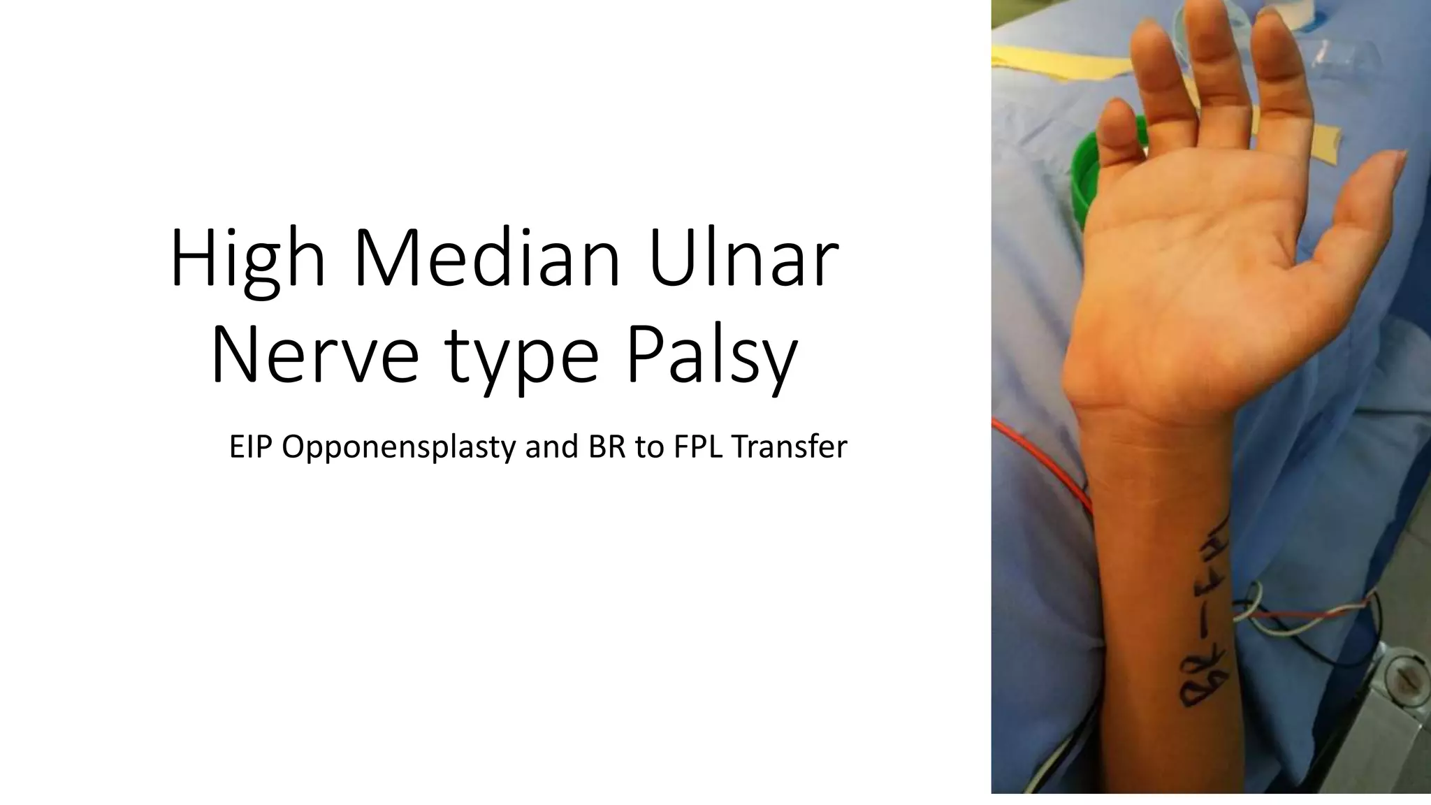 High median ulnar nerve type palsy | PPTX | Death, Injury, or Military ...