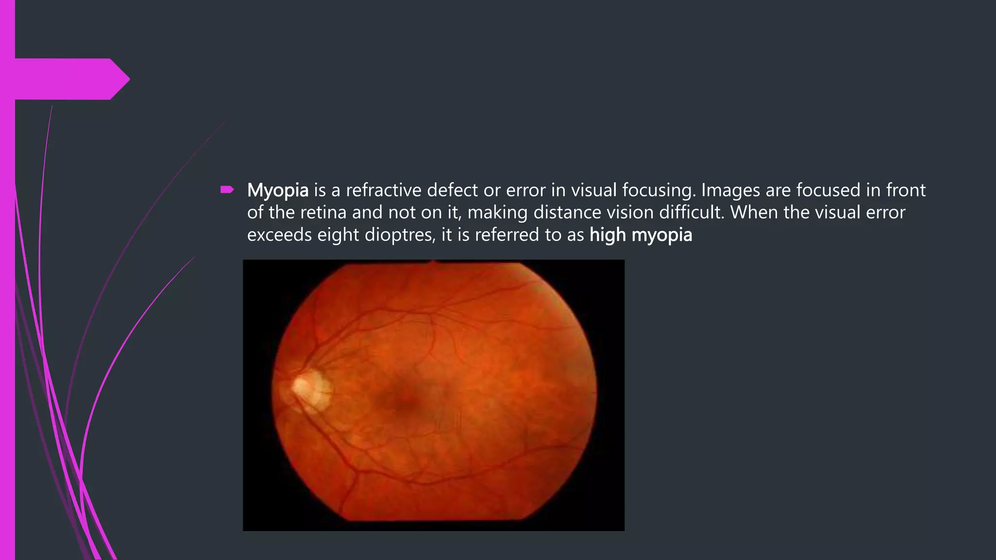 High myopia.pptx