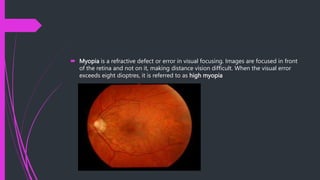 High myopia.pptx