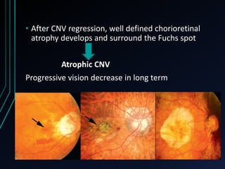 High myopia and management | PPTX